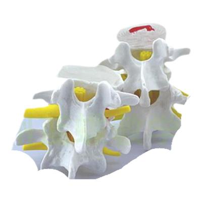 蓝蝶四阶段病变腰椎模型