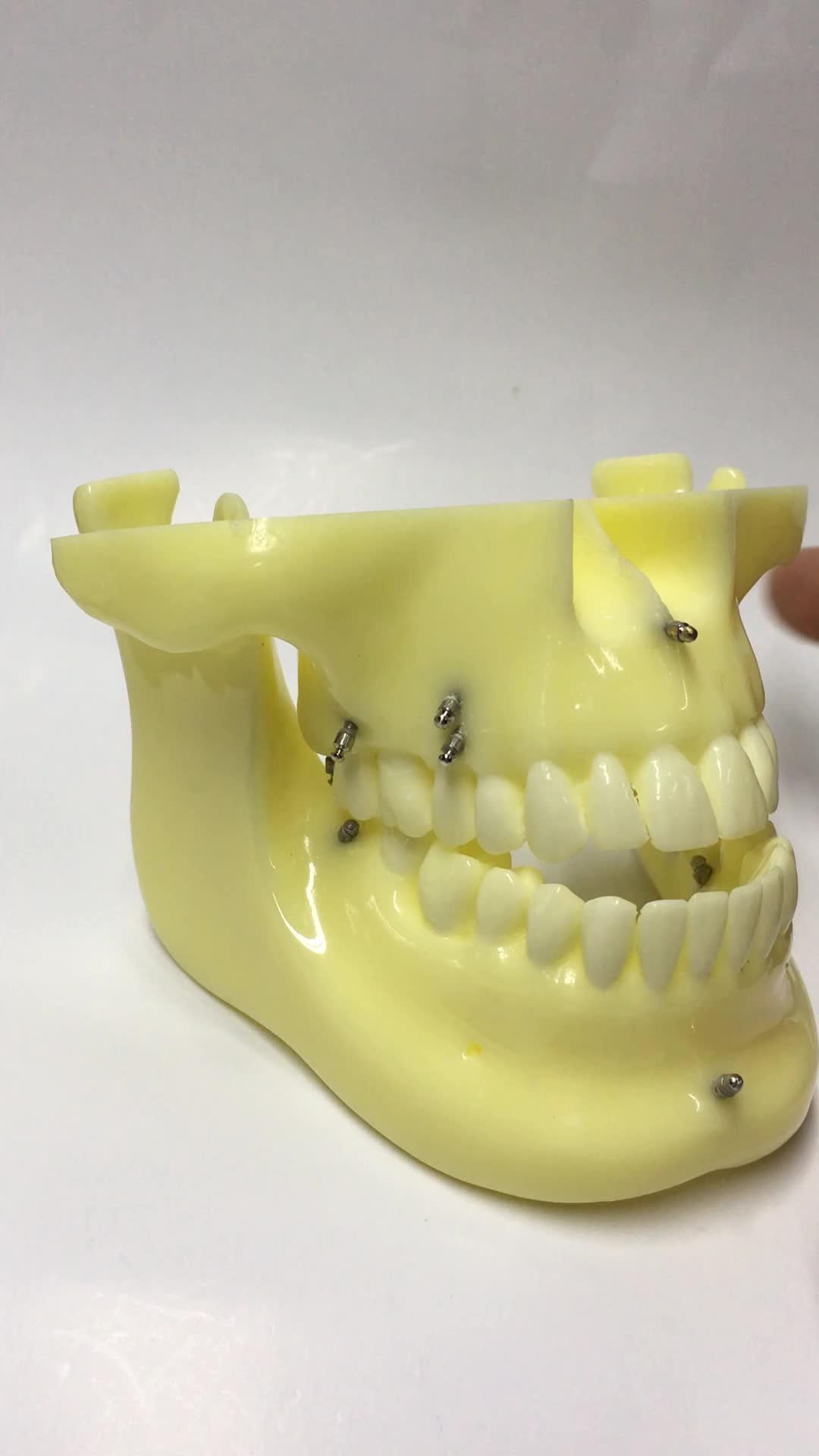 Orthodontic Implant Teeth Model For Demonstrationthe Exact Position Of ...