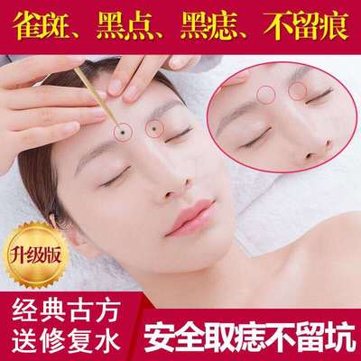 取痣黑点药水无痕正品黑痣去痦子点斑膏雀斑去斑脸部痣修复神器笔