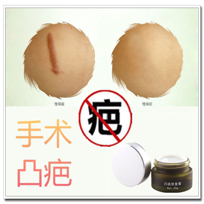 去除儿童专用增生性疤痕体质药膏祛耳洞凸起硬疙瘩液修复消平疤贴