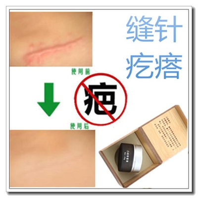 祛男女士脸部冻伤黑色素沉着去除烟烫伤手术凹凸起疤痕灵软膏正品