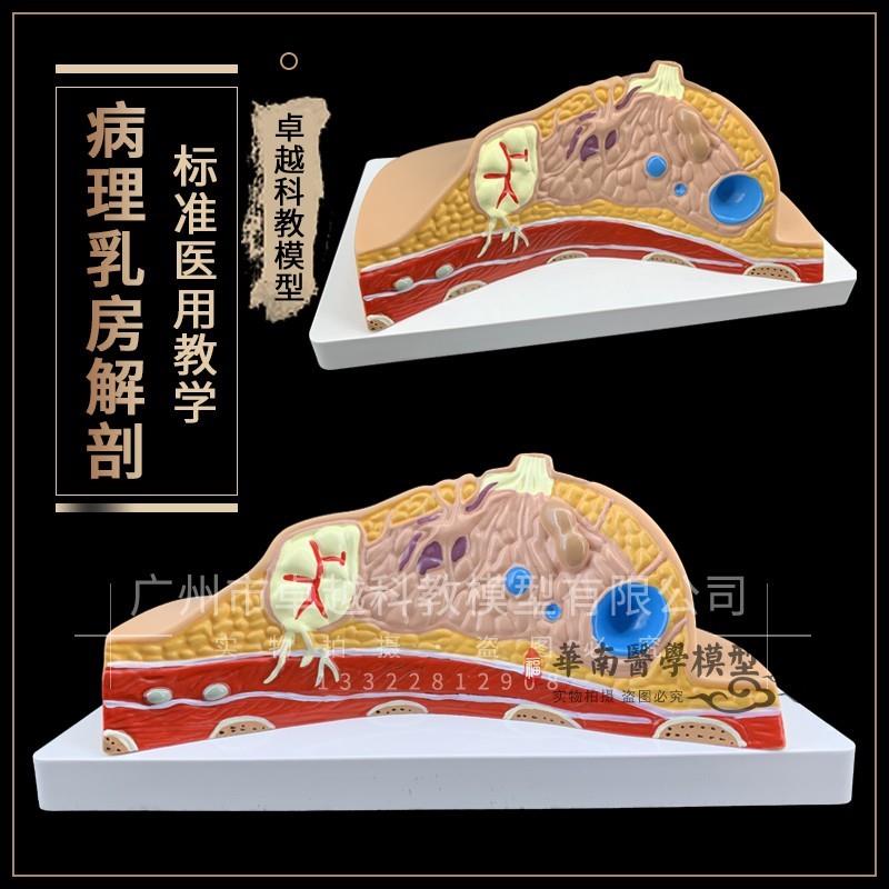 包邮教学病理乳房模型乳腺病变模型乳房解剖模型人体乳房素描标本