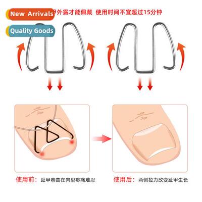 Ortho Wire Ingrown Nail Orthotics Ingrown Nail Ortho Wire To