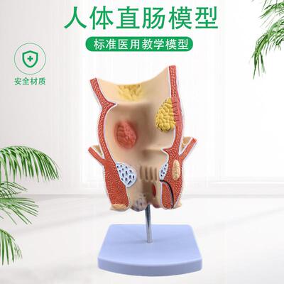 痔疮直肠病理模型 溃杨性结肠病 肠直肠解M剖病理模型病态疾病教