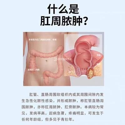 肛周脓肿特药物肛瘘克星效拔毒拔脓封口膏术后坐浴消炎医用凝胶YU