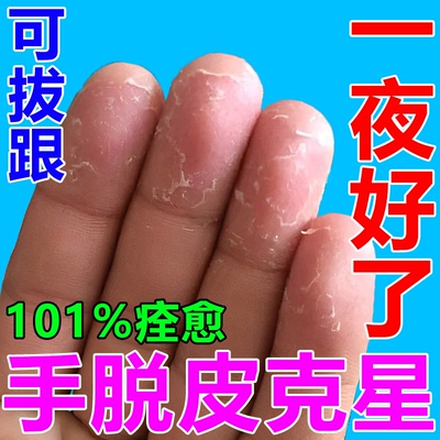【干裂蜕皮不用怕】手脱皮严重专用真菌蜕皮干燥起皮手指皴裂药膏