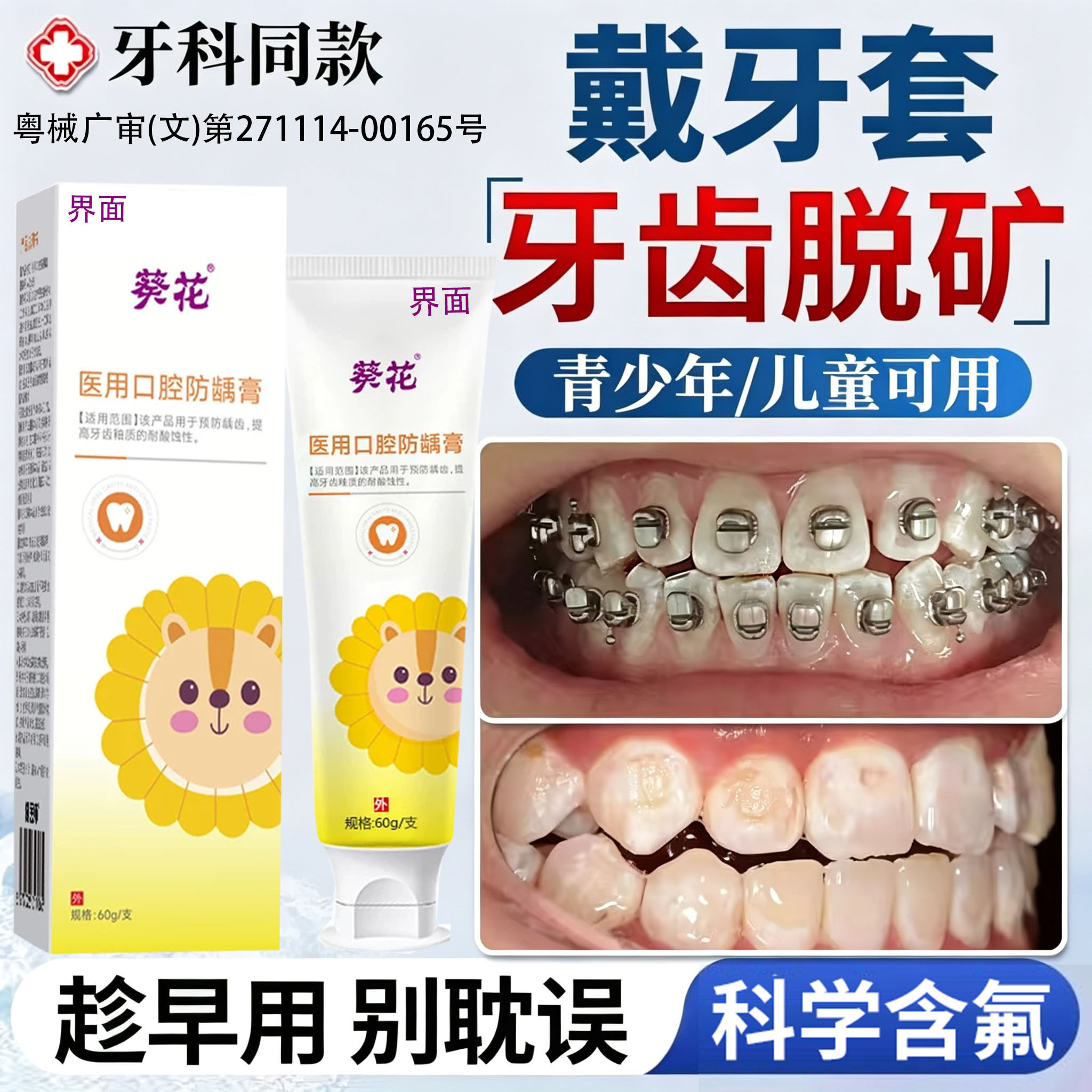 儿童戴牙套牙齿脱矿白斑含氟再矿化正畸牙膏矫正防龋专用护牙素PP