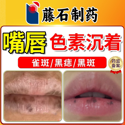 【嘴唇黑斑黑色素沉淀】药监备案
