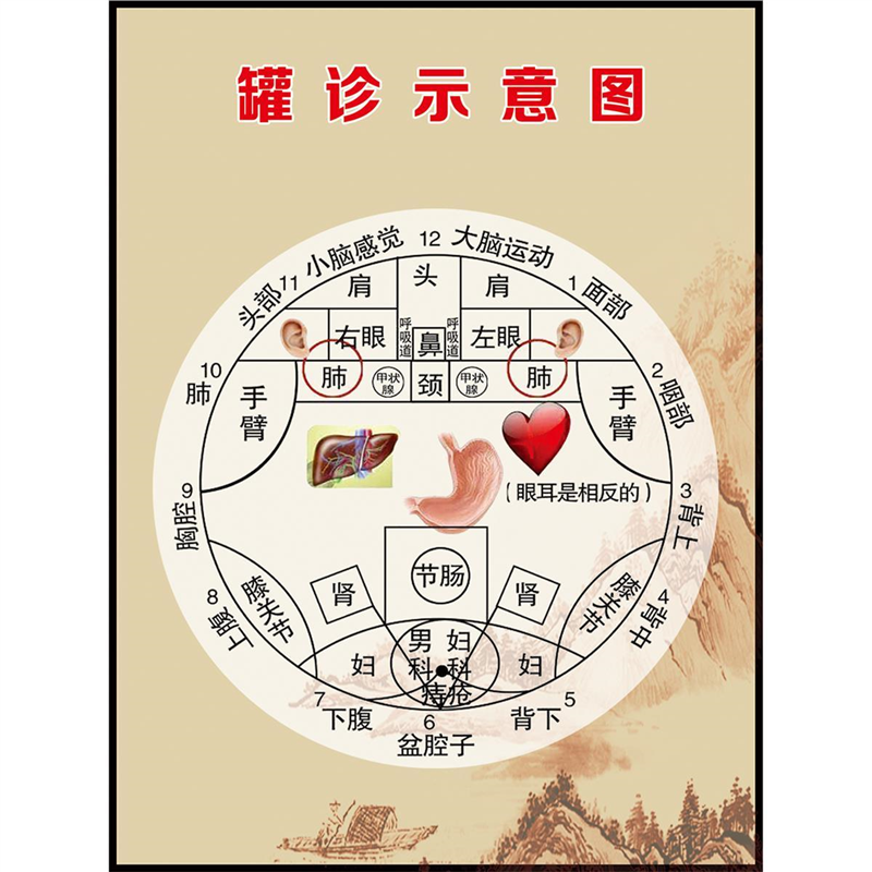中医养生经络罐诊示意图对应病症海报印制展板写真喷绘墙贴纸