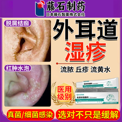 外耳道湿疹膏耳朵发炎止痒去真菌感染根耳朵后起皮屑皲裂干痒JQ