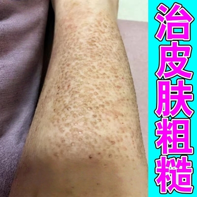 皮肤淀粉样变专用药治疗顽固皮痒斑小腿后背粗糙颗粒苔藓蛋白沉积
