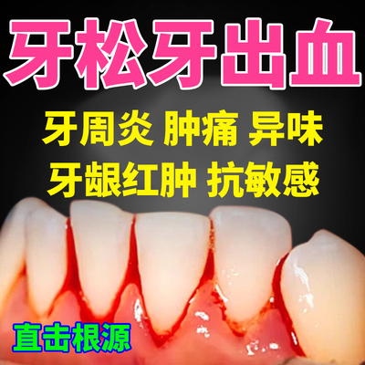 牙龈出血牙肉红肿退缩牙齿敏感牙根松动牙周炎专用喷剂WT