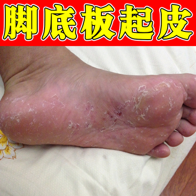 脚底板起皮真菌脚痒脚干燥粗糙脚脱皮掉屑脚掌脚心起水泡外用软膏