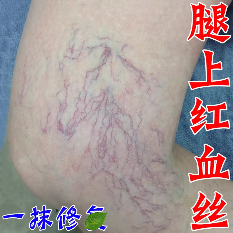 腿上有红血丝腿部青筋凸起蚯蚓腿