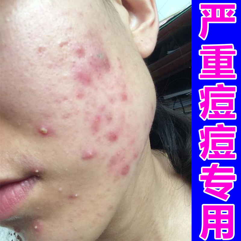 专冶脸上反复冒痘内分泌失调脸颊红肿硬块疙瘩