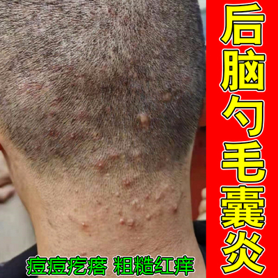 后脑勺毛囊炎头上长痘痘疙瘩脓包硬块粗糙掉屑头上痒毛囊堵塞修护
