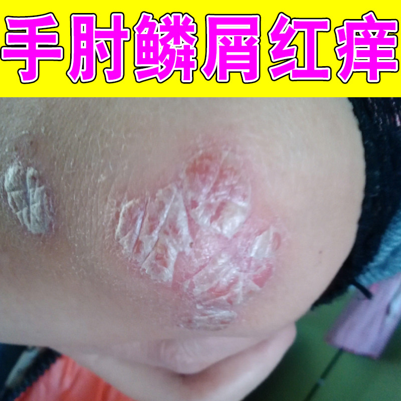 手肘鳞屑红痒胳膊肘长红斑掉屑粗糙干燥痒神经性角质层增厚修护膏