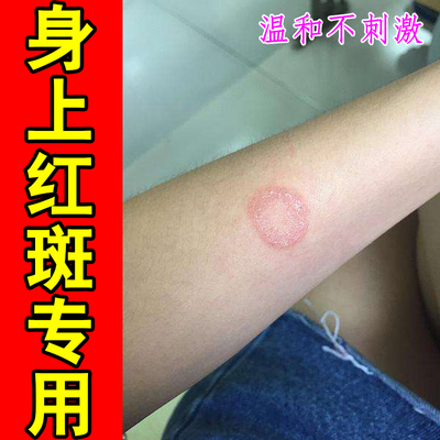 胳膊上长红斑圆形斑干燥粗糙痒掉屑粗糙身上铜钱圆斑痒感染草本膏