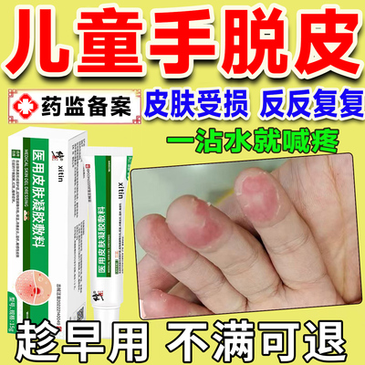 儿童手指指尖手脱皮起皮专膏真菌感染手用癣干燥裂疼痒蜕皮发红LT