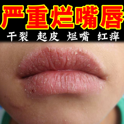 嘴角长水泡嘴唇反复干裂起皮药乳