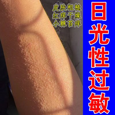 日光性干燥痒起疙瘩手背粗糙胳膊红肿刺挠干痒专用修复