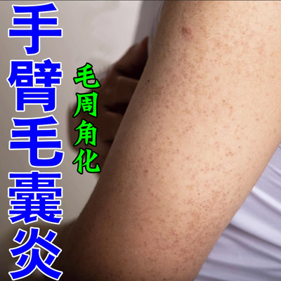 手臂毛囊毛周角化胳膊上小疙瘩皮肤痒前胸后背毛囊毛囊堵塞痒