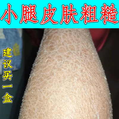 小腿皮肤粗糙身上起鳞屑干燥痒毛周角化皮肤掉屑蛇皮肤秋冬天气干