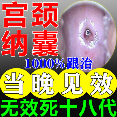 宫颈纳氏囊肿药宫颈肥大息肉慢性宫颈炎卵巢囊肿子宫肌瘤妇科凝胶