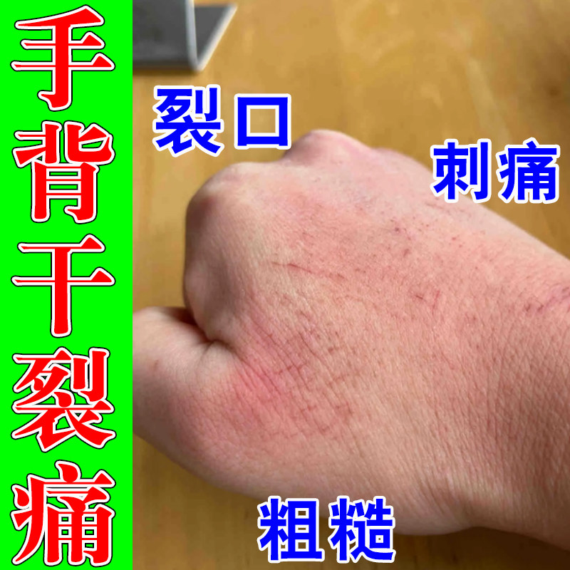 手皮肤干燥手足裂口干裂秋冬保湿滋润手皴粗糙起皮皲裂护手霜
