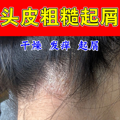 冶头皮斑块头痒疼红肿结痂头部周围大片白色鳞屑草本乳膏