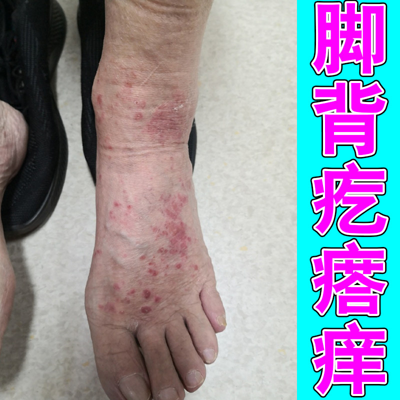 反复脚痒脚面上起红疹子水泡疙瘩小红点红斑越挠越痒软膏