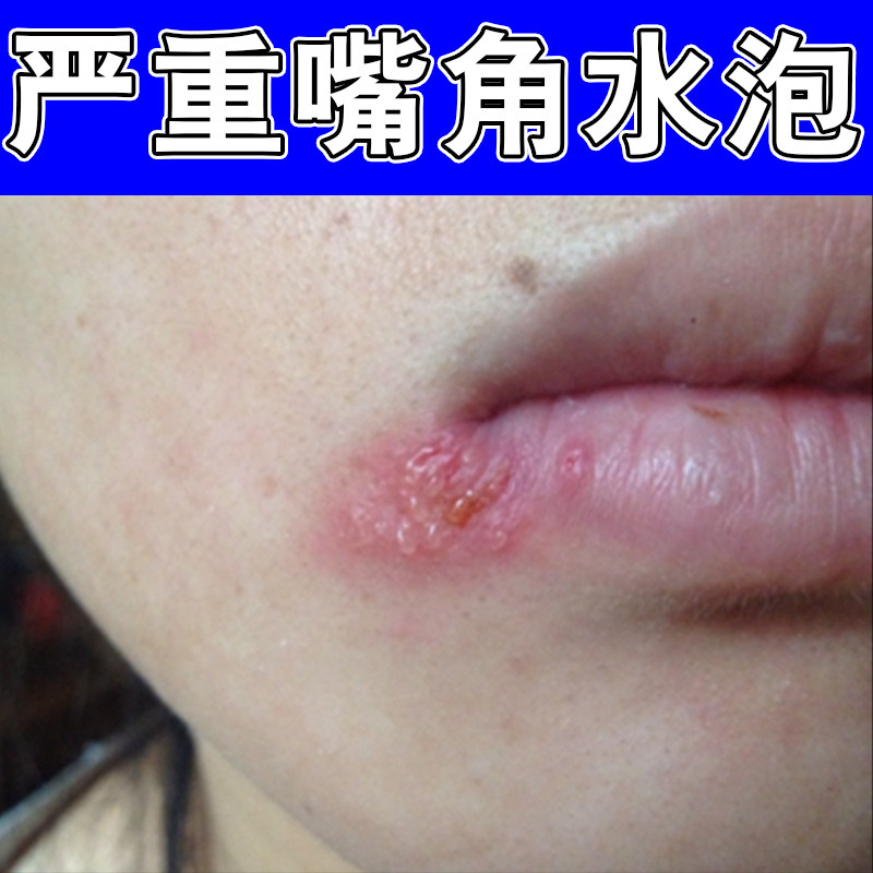 舒缓唇部上火起泡修护嘴角干裂起皮改善口角泛红水泡保湿护唇乳膏