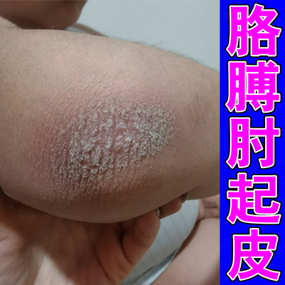 胳膊肘粗糙起皮掉屑脓包鳞屑专用痒草本药干痒身上长红斑起疙瘩