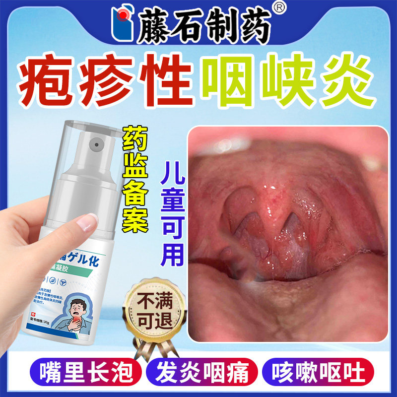 疱疹性咽峡炎儿童喷雾剂咽喉炎慢性咽炎除根口腔疱疹咳嗽异物感OM