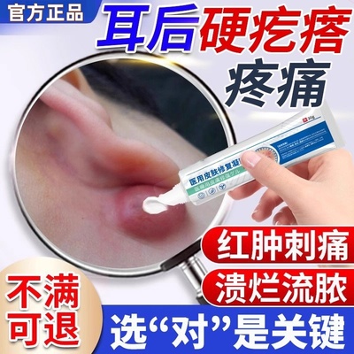 耳后鼓包硬块痘皮脂腺囊肿粉瘤疖肿拔毒拔脓专用火疖子敷料贴膏AA