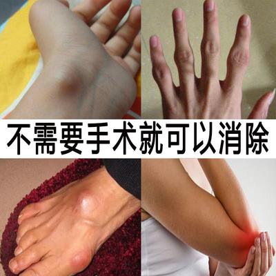 手腕大拇指腱鞘炎膏药腱鞘囊肿专用膏舒筋贴鼓包治疗痛舒贴网球肘