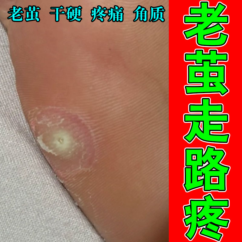 脚底老茧脚趾脚底厚硬茧脚钉角质足部肌肤舒缓养护修护贴