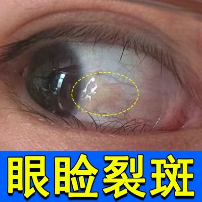 睑裂斑眼药水去除黄斑病变眼白发黄治疗眼睛有异物眼红看不清滴液