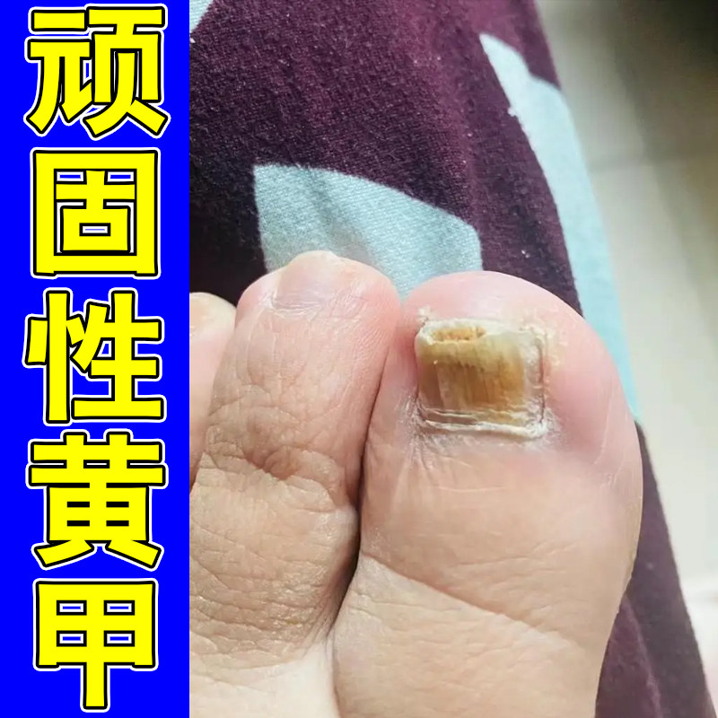 脚趾甲增厚变黄空黑白手指甲甲肉分离修复亮甲厚甲舒缓草本修护膏