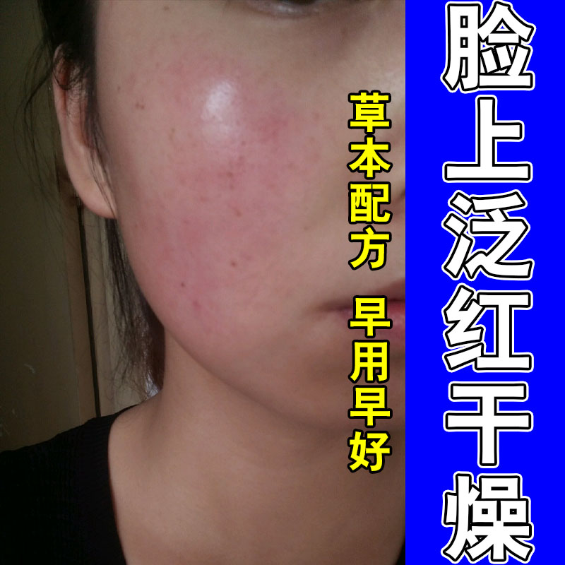 脸上的红血丝皮肤角质层薄修复大红脸面部泛红屏障舒缓保湿乳膏