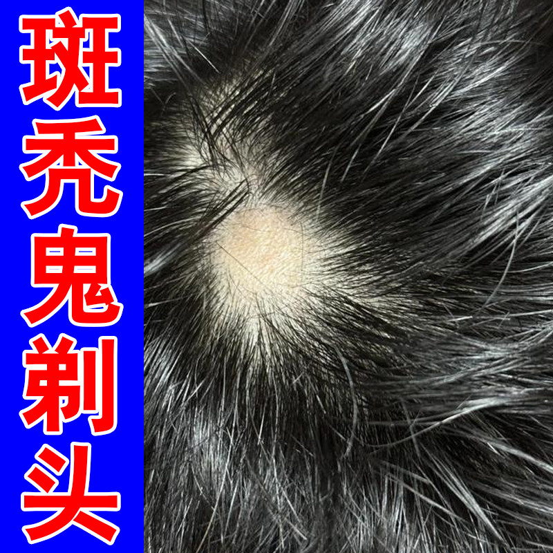 块状脱发斑秃头皮护理精华温和滋养发根改善头顶秃斑掉发男女日常