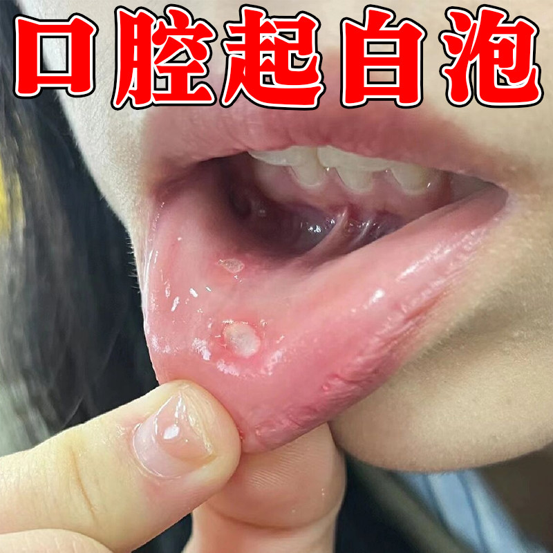口腔上火嘴巴舌头烂嘴唇里面起泡白点疼痛溃破口腔喷剂