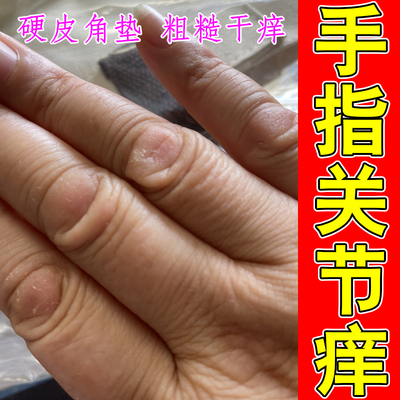 冶茧子指节增厚关节硬疙瘩指节硬皮手部老茧关节粗糙手指起皮手指