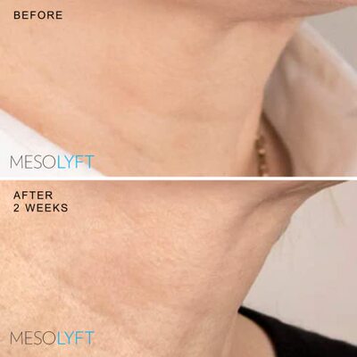 极速MesoLyft Neck Renewal & Lip Plumper Combo
