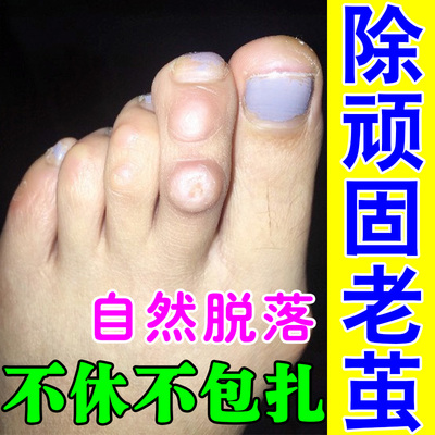 老茧去除软化剂脚茧小脚