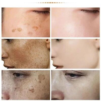 Niacinamide Melasma Brightening Cream Reduce Melanin Lighten