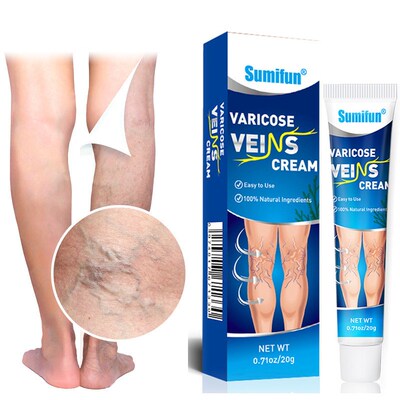 Varicose Veins relieves Cream Leg Vasculitis Phlebitis Spide