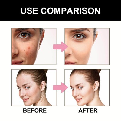 Hoygi Cute Black Acne Patch - Reduces spots, blackheads, and