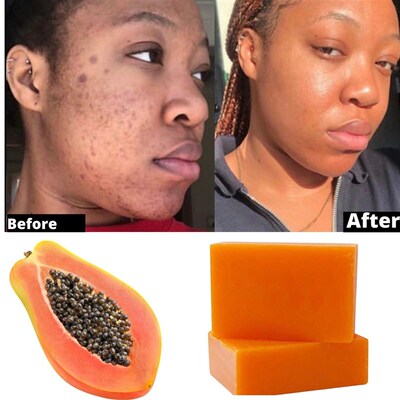 Kojic Acid Bar Soap, Dark Spot Remover, Lightening Bar Soap,