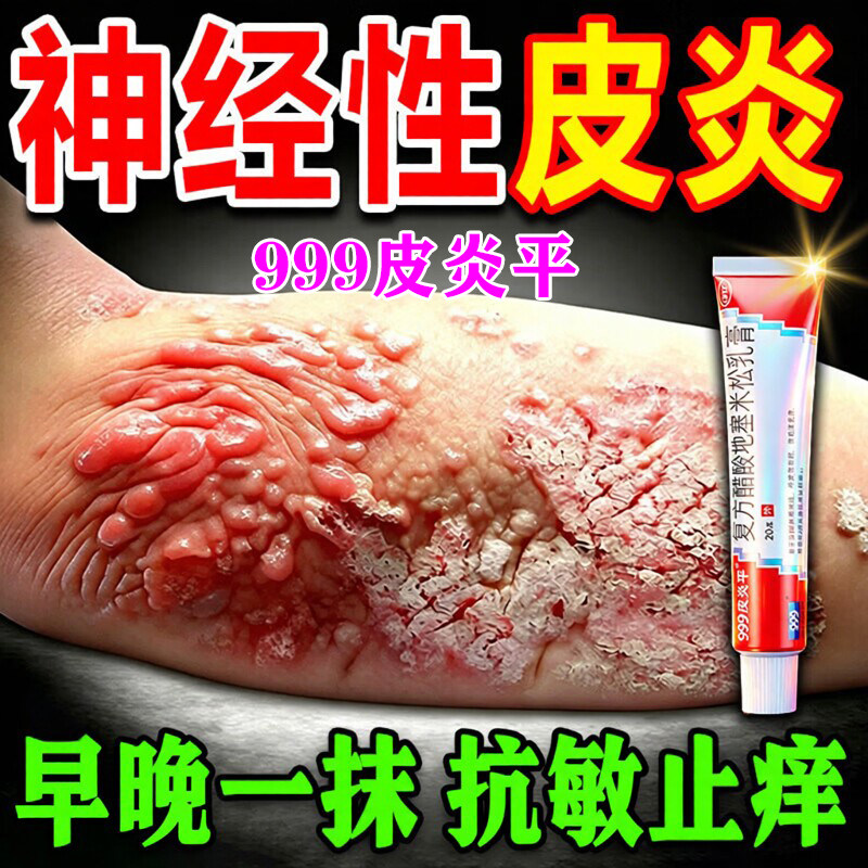 神经性皮炎特药效皮炎瘙痒湿疹止痒膏抗菌消炎999皮炎平软膏正品